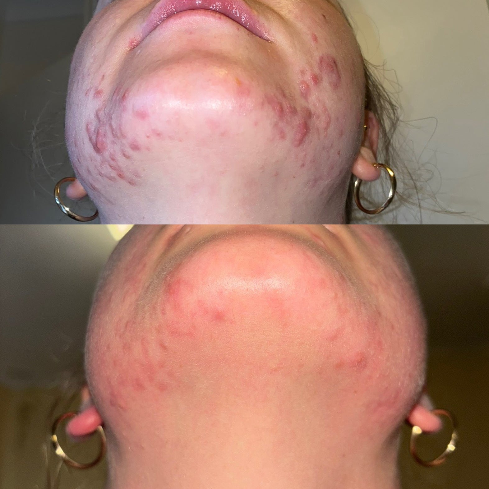 Cream for Stubborn Breakouts – Resq Skin Pty Ltd